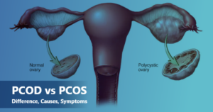 PCOD vs PCOS: Difference, Causes, Symptoms - Oncquest Blog- Your Health ...