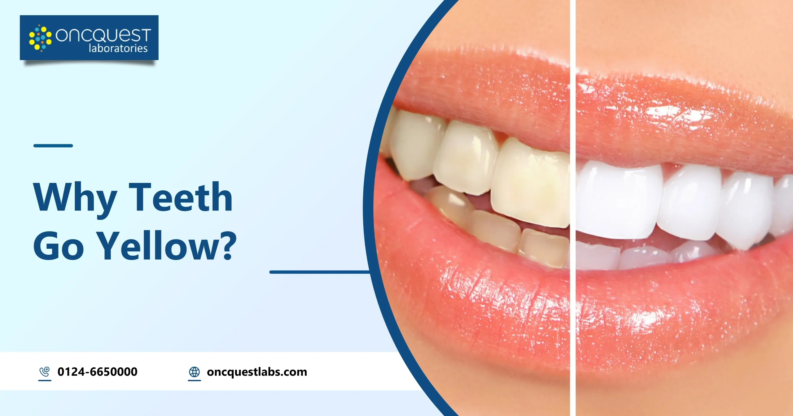 Why Teeth Go Yellow- Causes and Maintaining