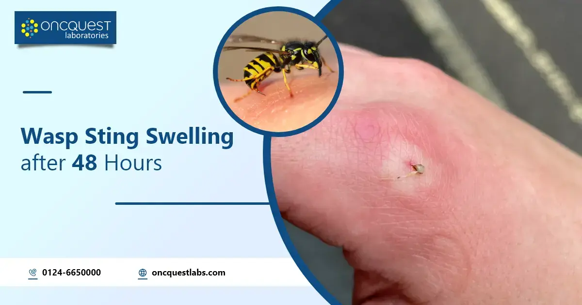 Paper Wasp Sting Swelling